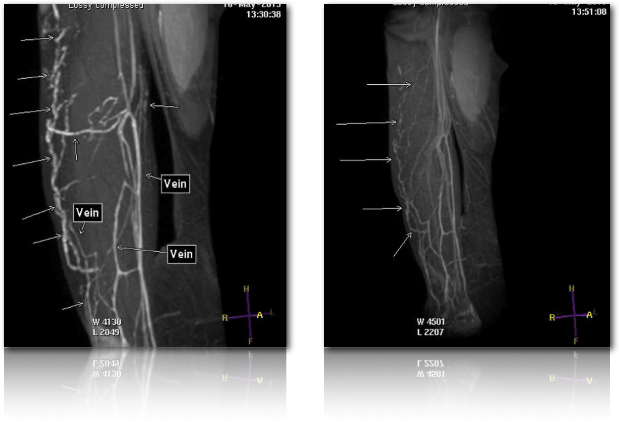 Lymphedema Network of Excellence - Department of Surgery