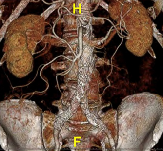Vascular Surgery Research - Department of Surgery