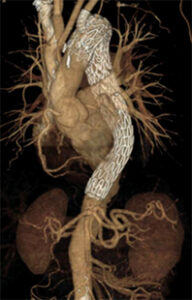 Vascular Surgery Research - Department of Surgery